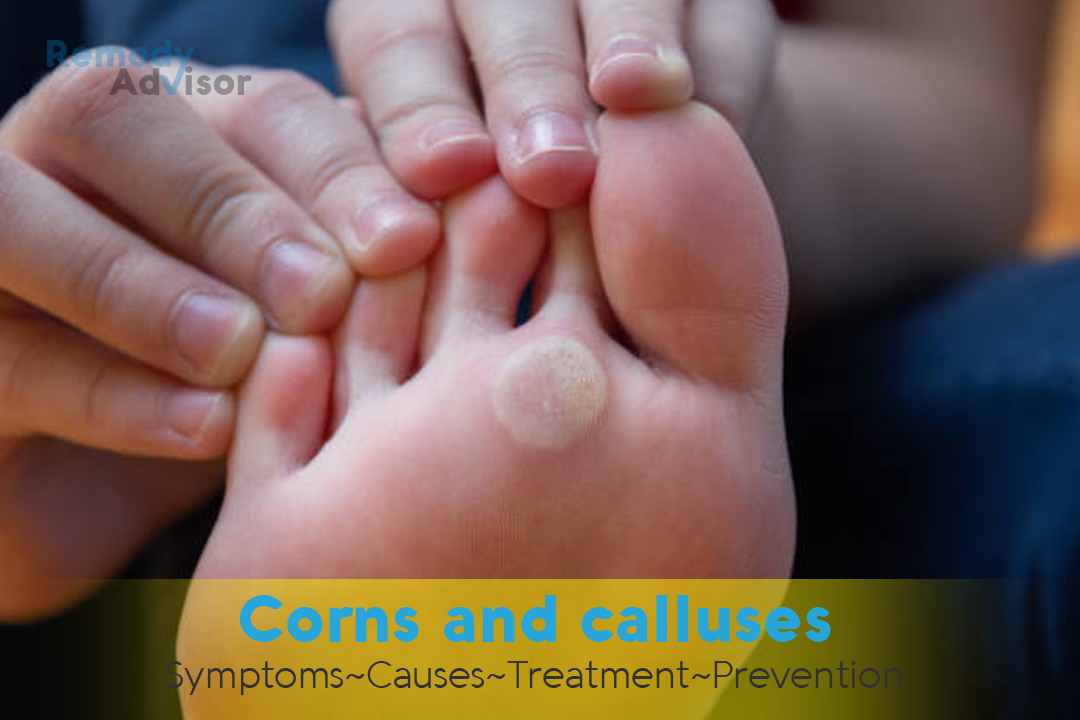 Corns and calluses – Remedy Advisor