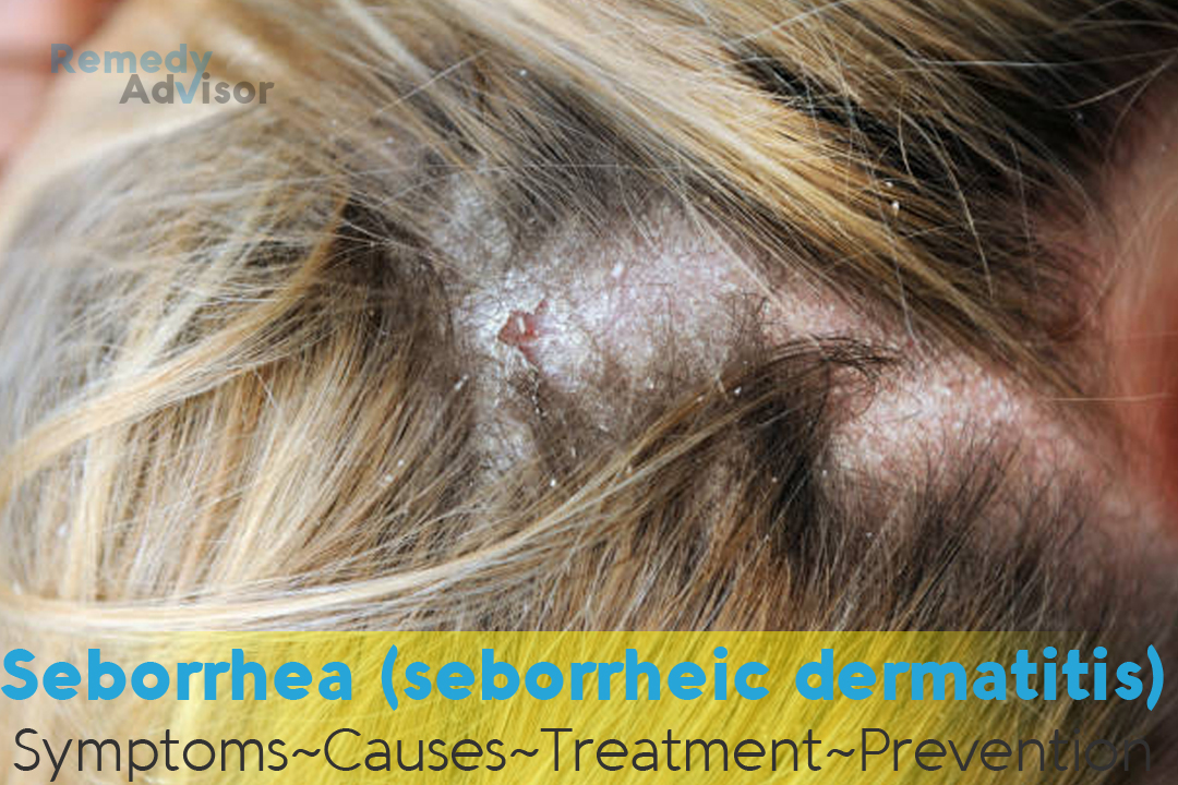 Seborrhea (seborrheic dermatitis) – Remedy Advisor