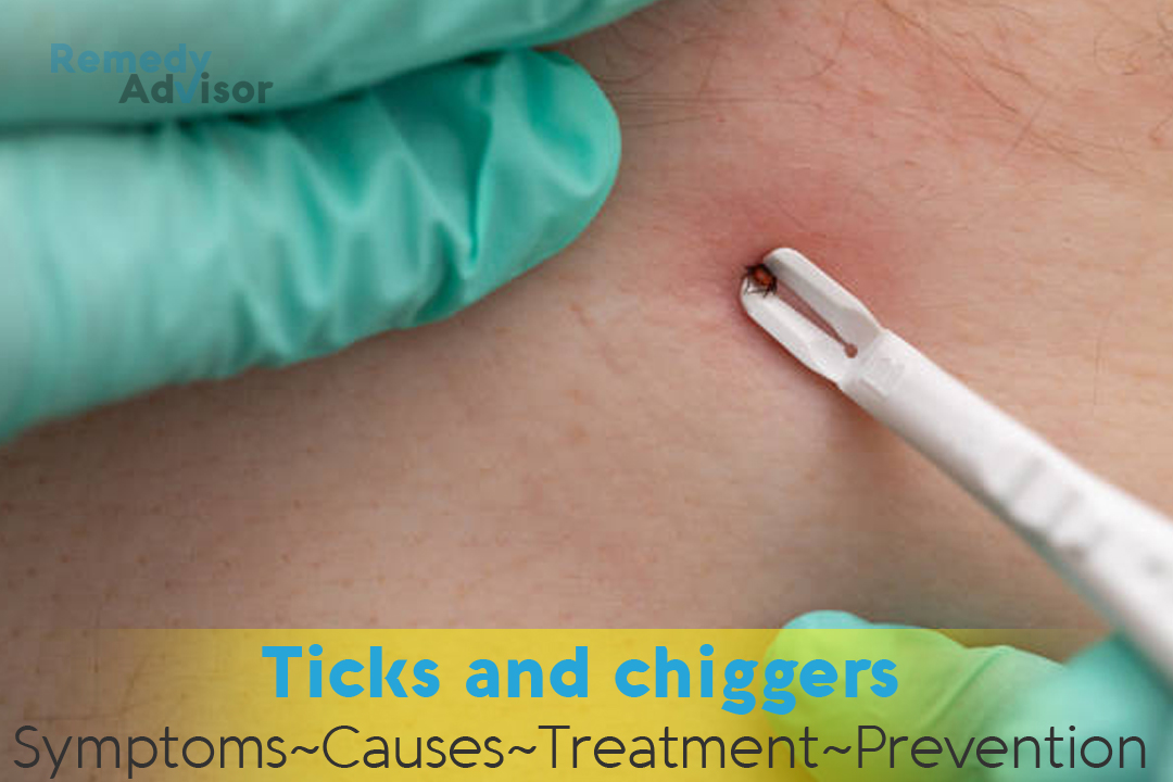 Ticks and chiggers – Remedy Advisor